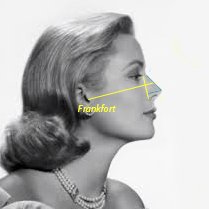 Goode's Method - Toronto Rhinoplasty Surgery - Nose Surgery by Dr ...