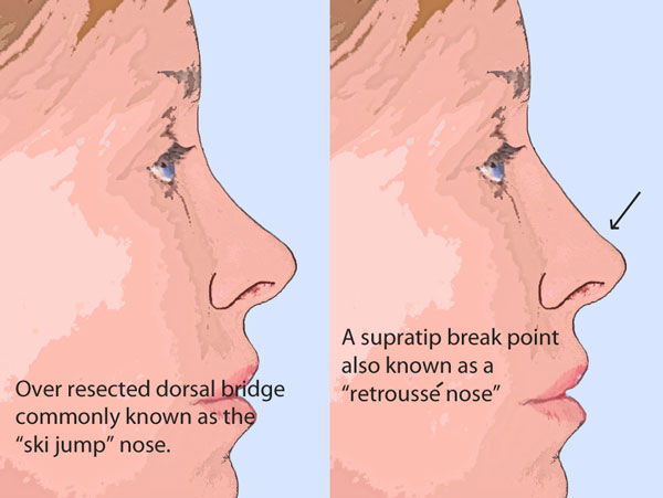 Nasal Beauty Surgery Procedures Toronto | Dr. Oakley Smith