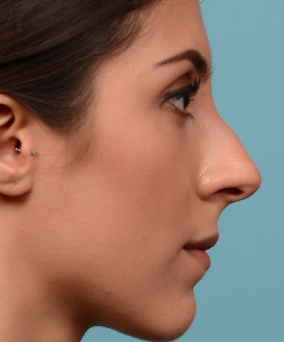 Rhinoplasty Surgeon Toronto Ontario