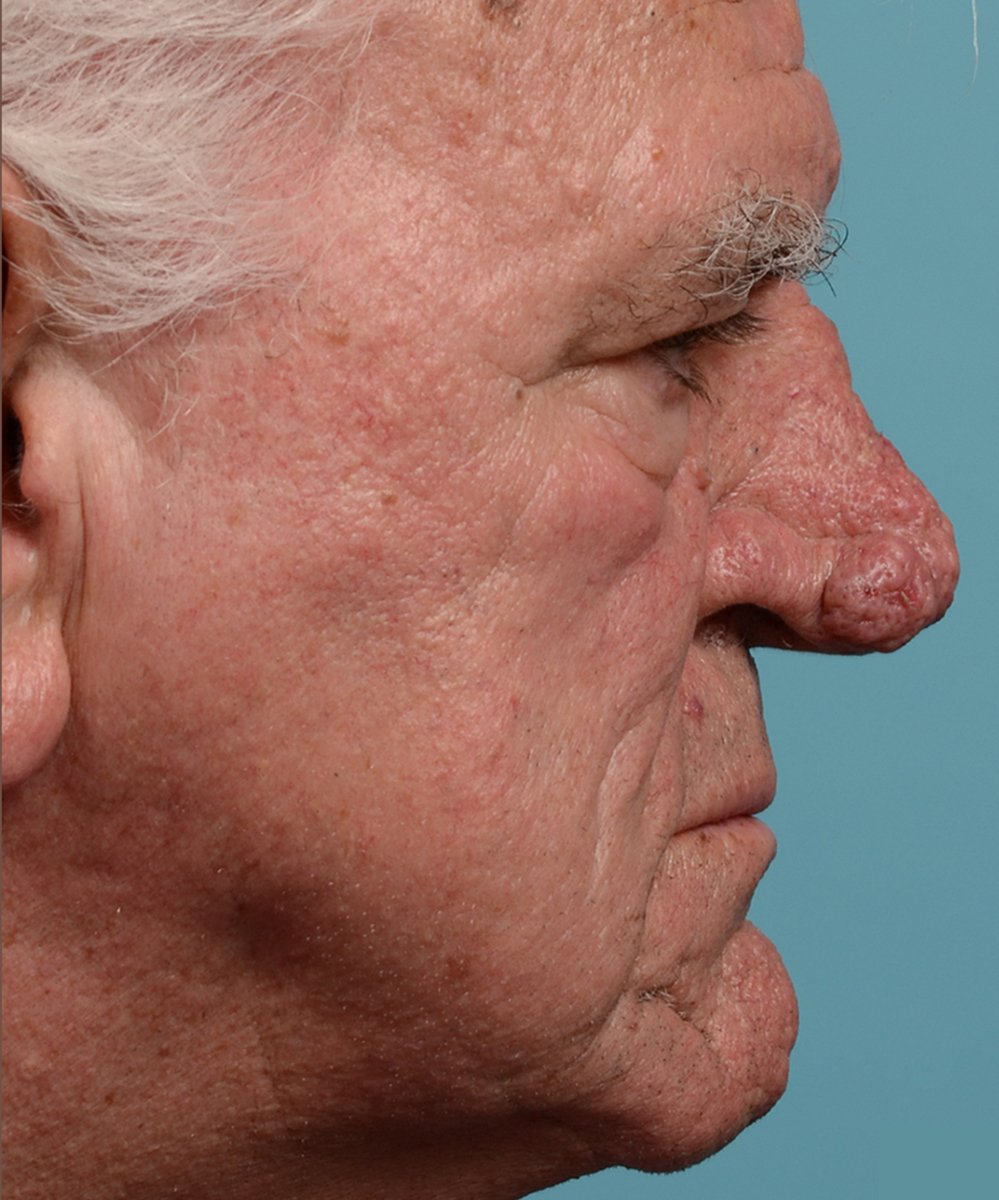 Rhinophyma Surgeon Toronto Dr Oakley Smith