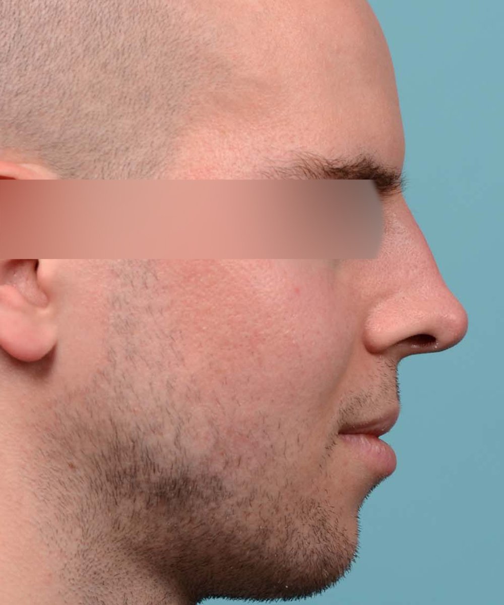 Rhinoplasty Before and After Case 278 - Toronto Rhinoplasty Surgery ...