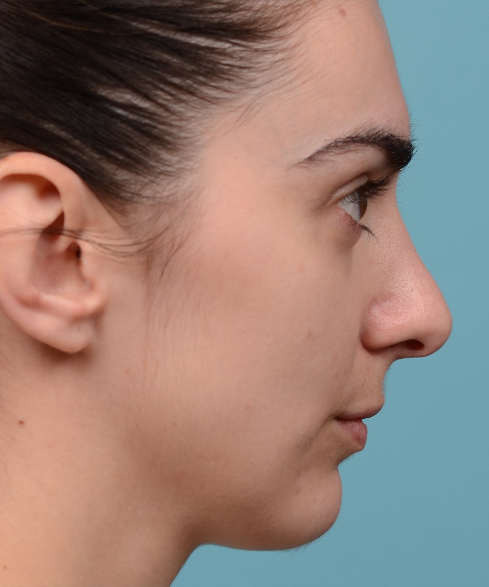 Rhinoplasty Before and After Case 288 - Toronto Rhinoplasty Surgery ...