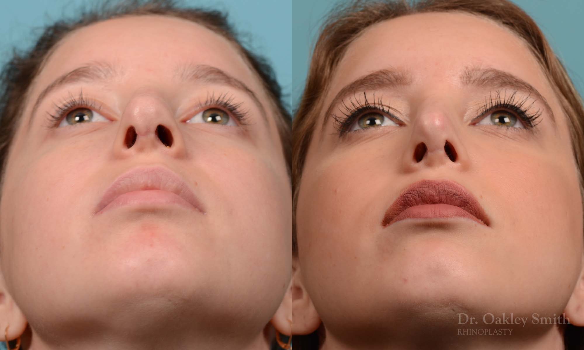 Dr Oakley Smith Rhinoplasty, Toronto ON Nose Job