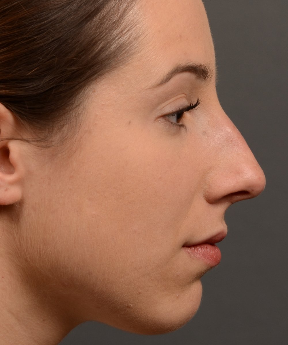 Rhinoplasty before and after case 378 - Toronto Rhinoplasty Surgery ...