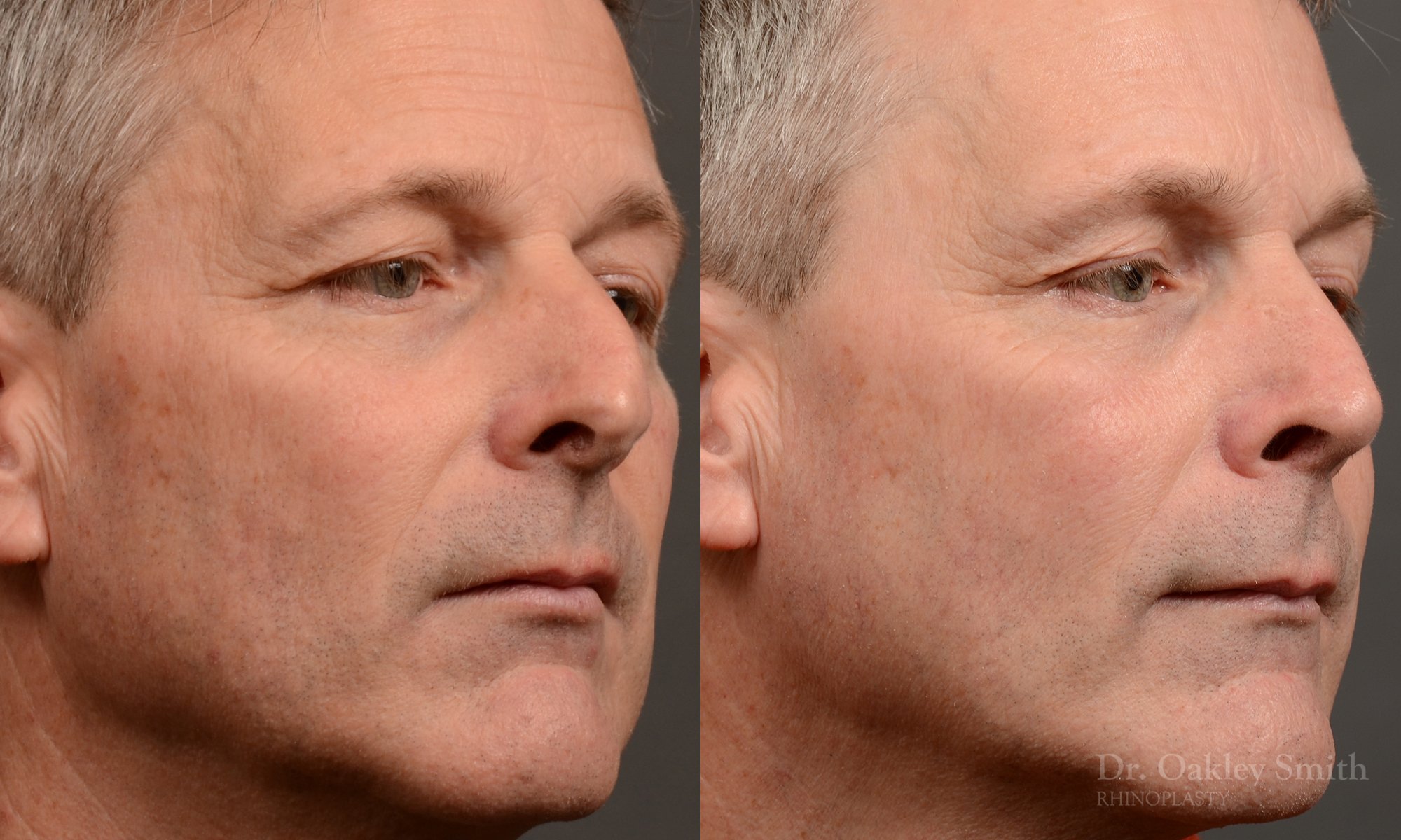 Rhinoplasty Before and After - Case 494 - Toronto Rhinoplasty Surgery ...