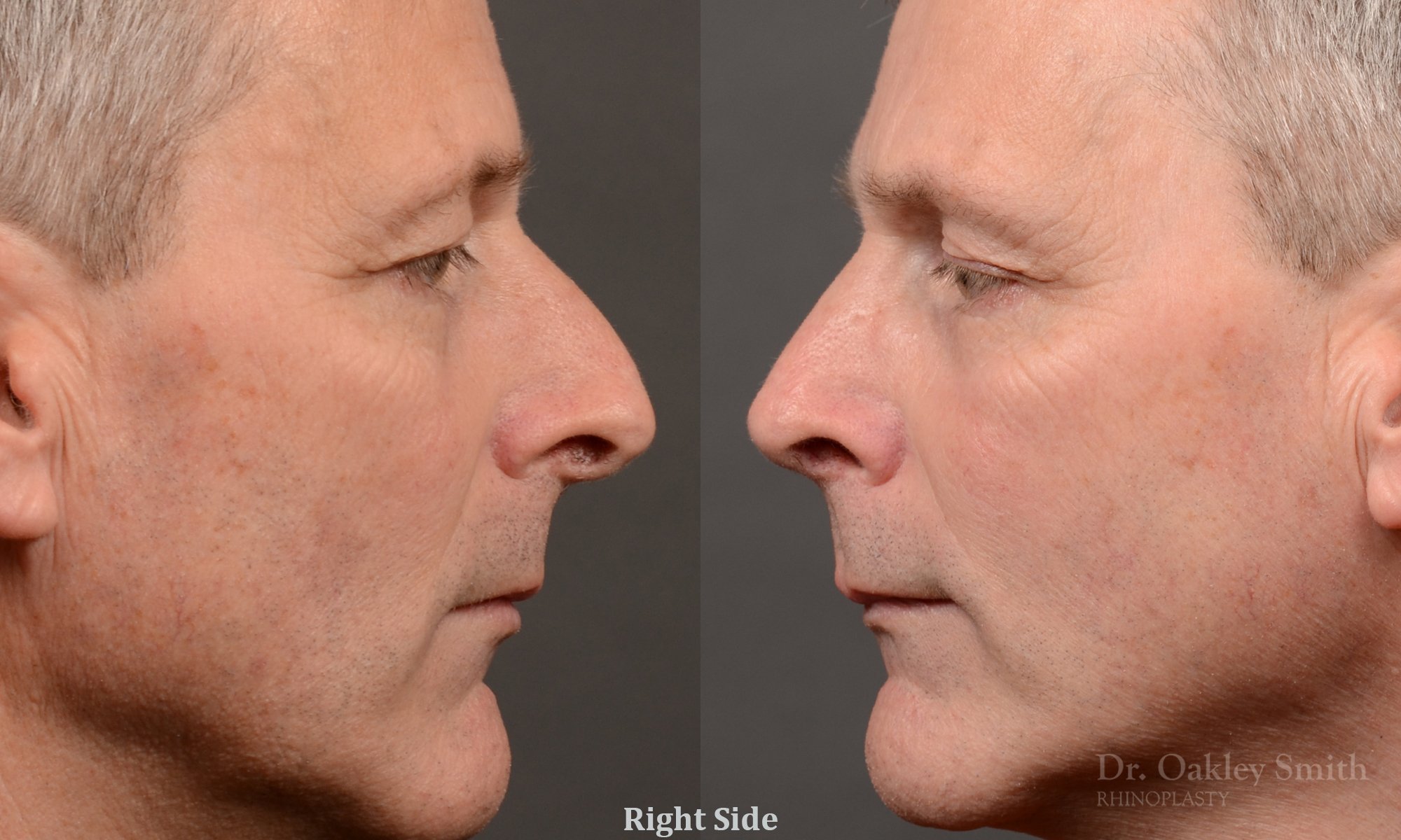 Rhinoplasty Before and After - Case 494 - Toronto Rhinoplasty Surgery ...