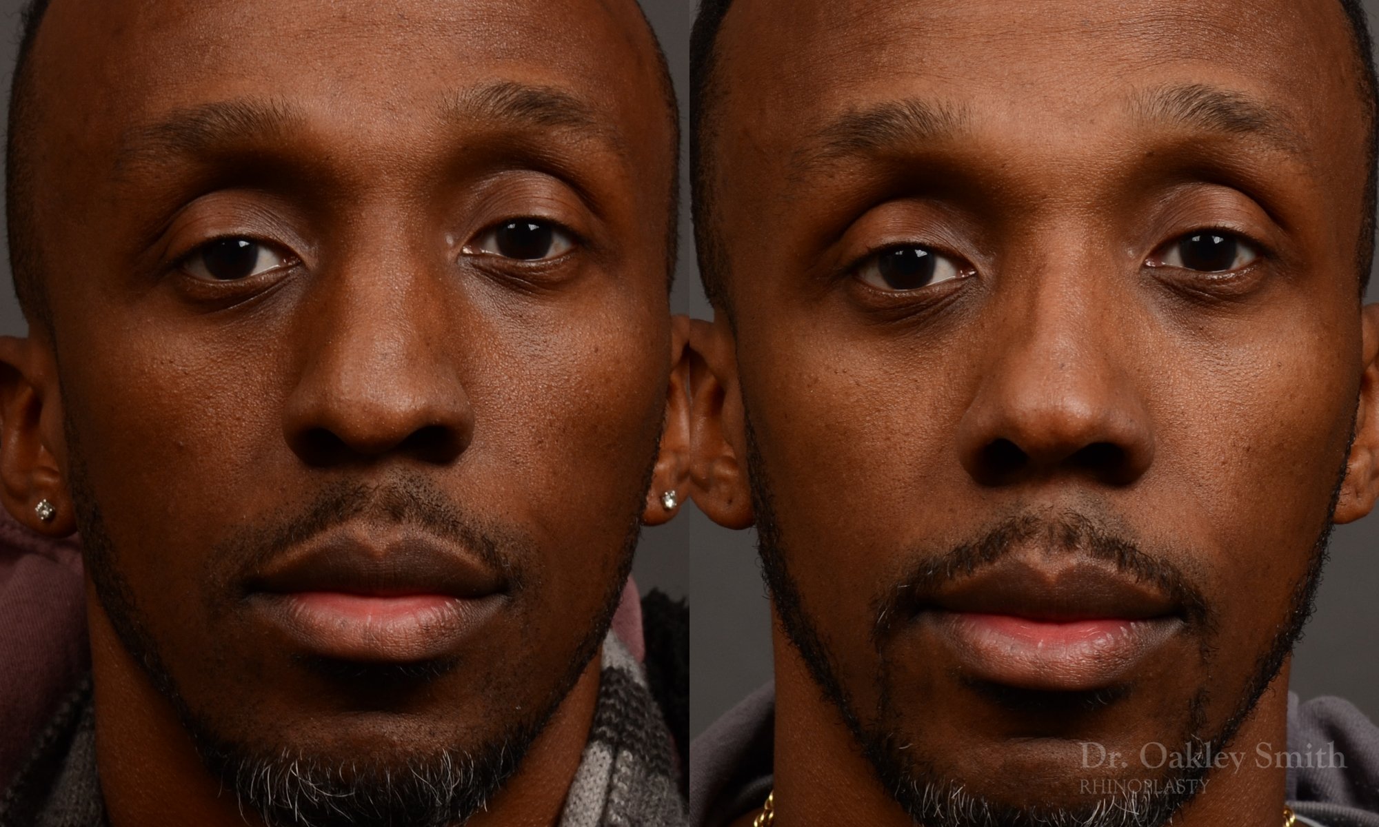 Septoplasty Before and After - Case 504 - Toronto Rhinoplasty Surgery ...