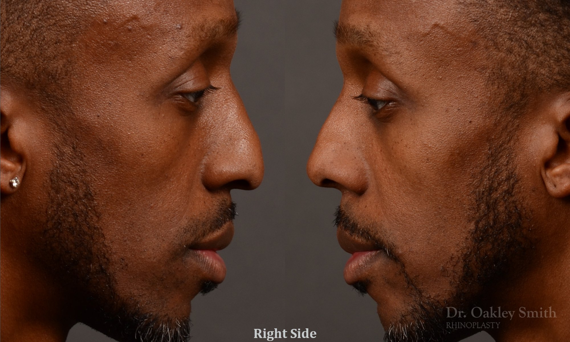 Septoplasty Before and After - Case 504 - Toronto Rhinoplasty Surgery ...