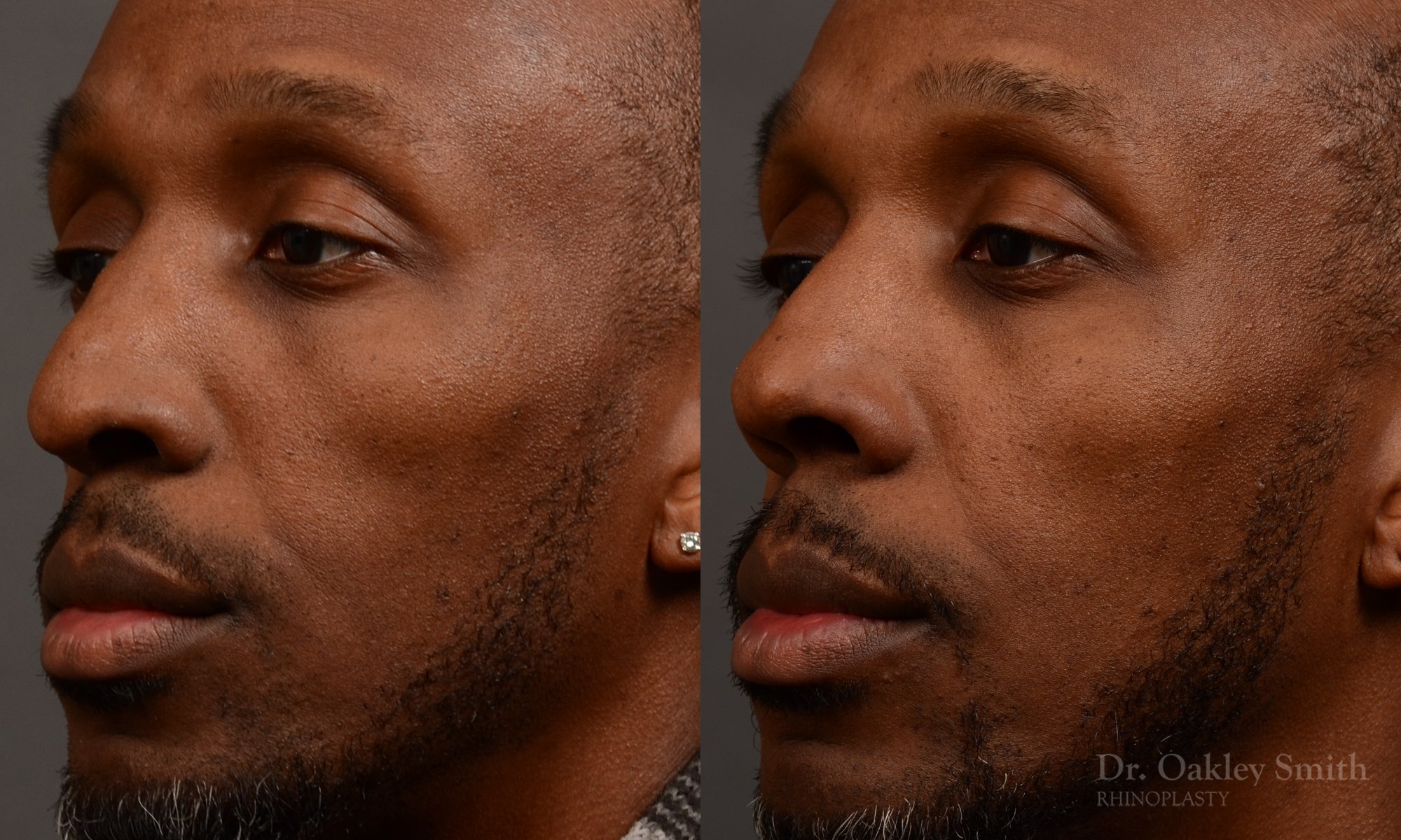 Septoplasty Before and After - Case 504 - Toronto Rhinoplasty Surgery ...