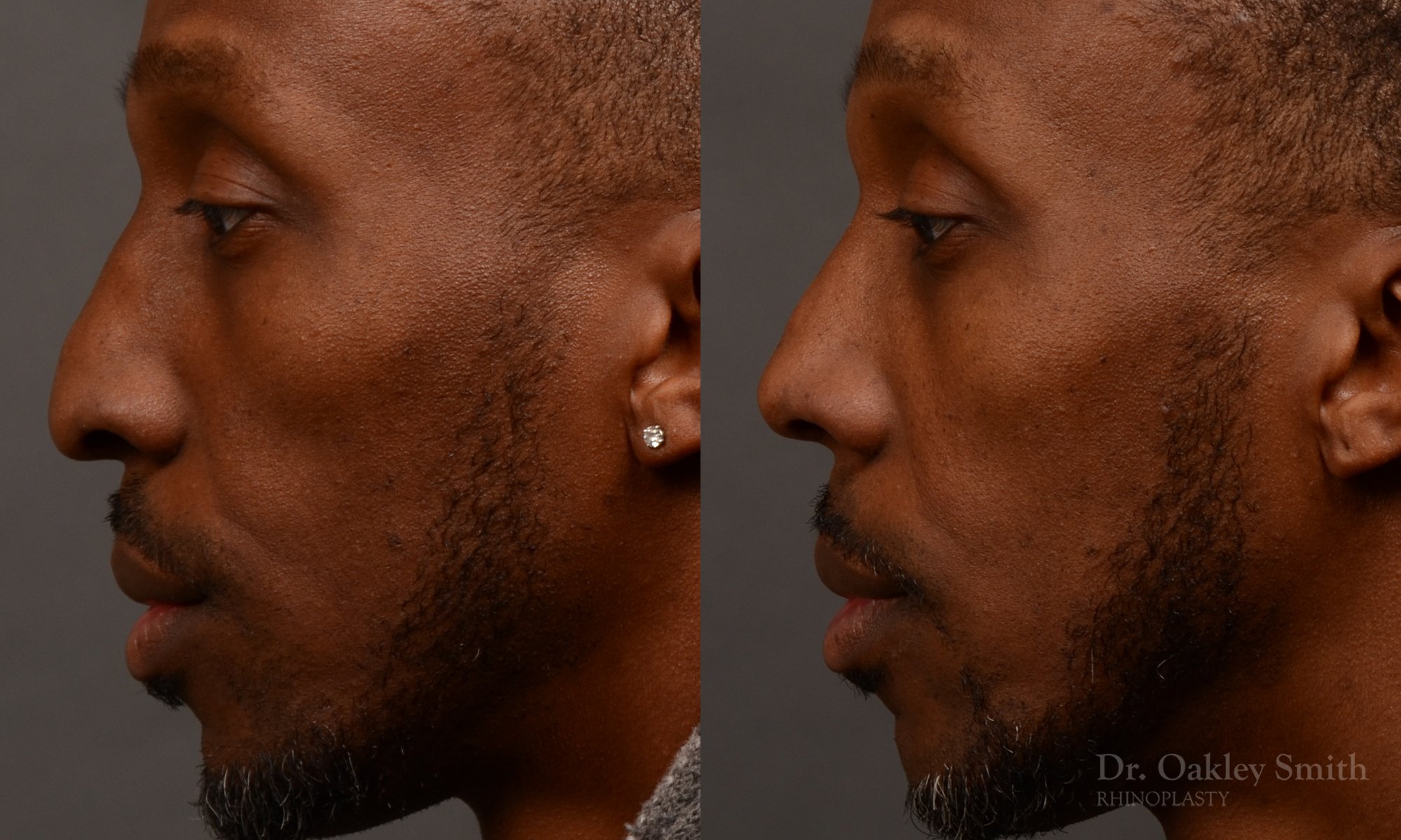 Septoplasty Before and After - Case 504 - Toronto Rhinoplasty Surgery ...