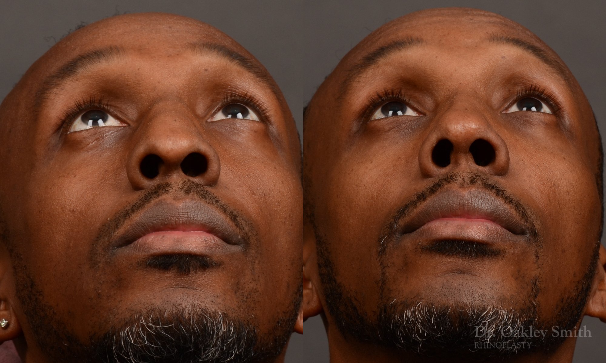 Septoplasty Before and After - Case 504 - Toronto Rhinoplasty Surgery ...