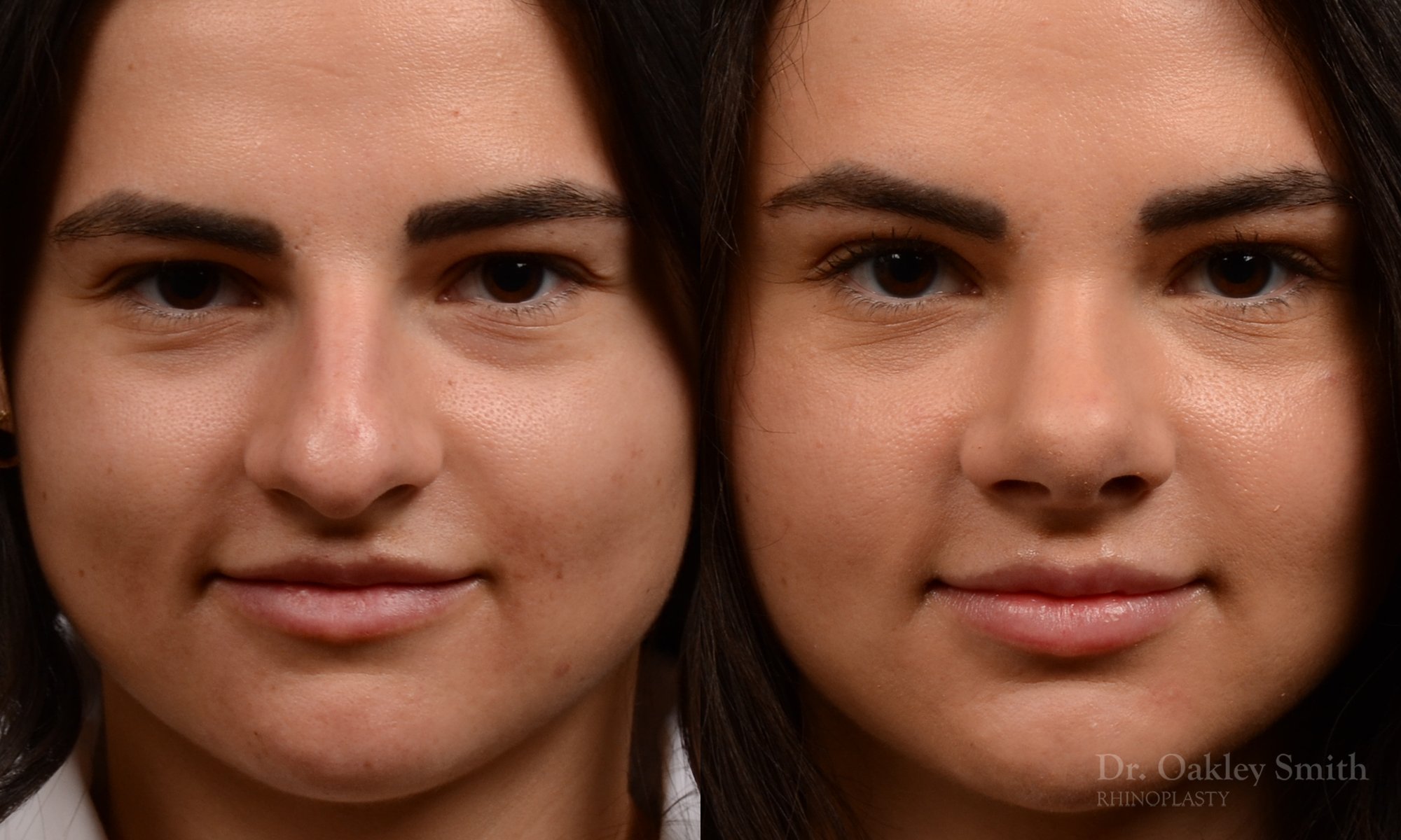 Septoplasty and Rhinoplasty Before After - Case 509 - Toronto ...