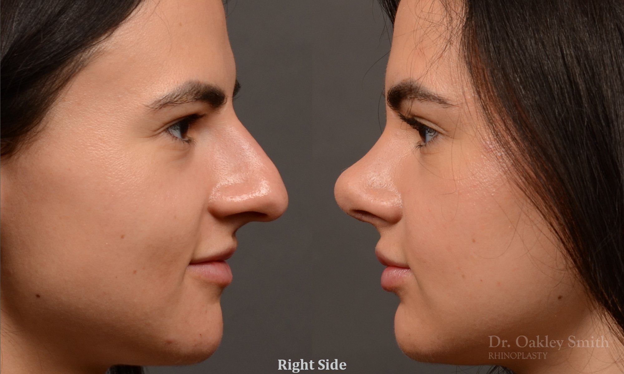 Septoplasty and Rhinoplasty Before After - Case 509 - Toronto ...