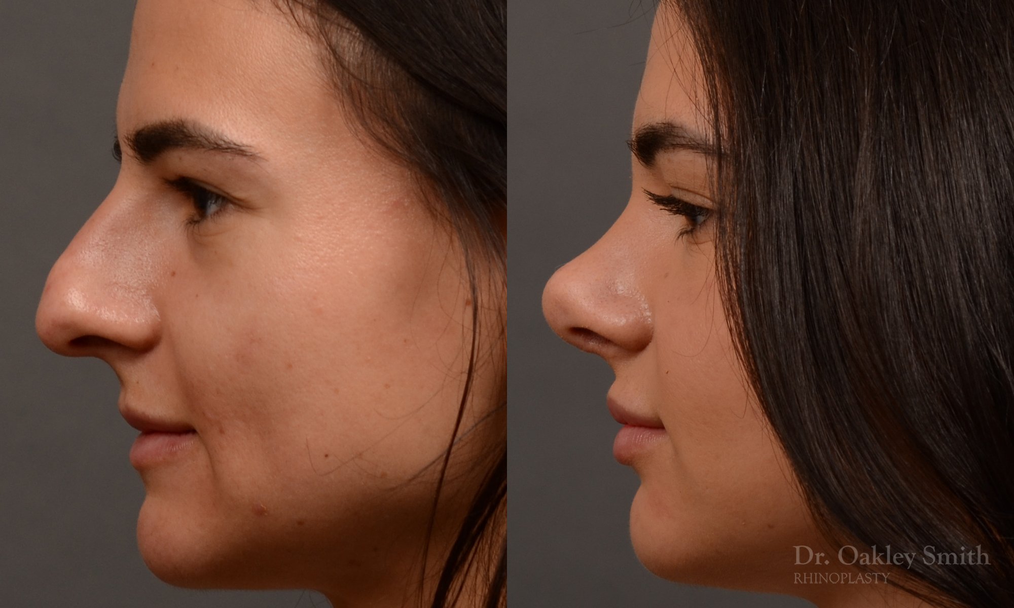 Septoplasty and Rhinoplasty Before After - Case 509 - Toronto ...